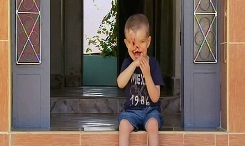 Jongen zonder neus, ogen en mond krijgt na operatie een nieuw gezicht ...