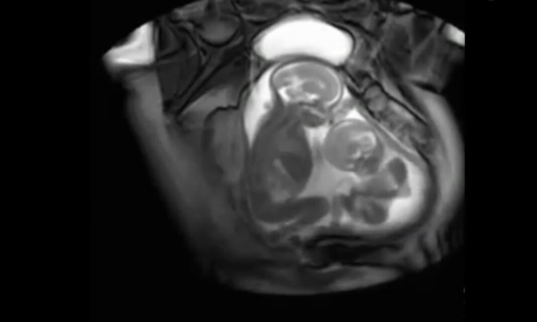 Mooie echo: tweeling 'vecht' om ruimte in de buik | Libelle