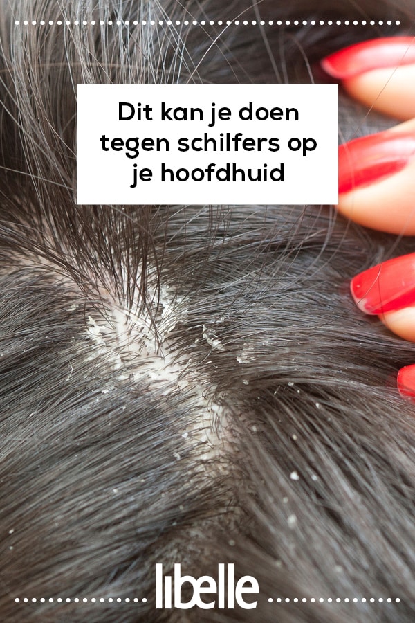 Schilfers op je hoofdhuid: waar komen ze vandaan en wat doe je ertegen ...