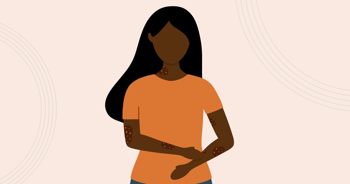 Wat is netelroos en wat kun je er tegen doen? Libelle legt uit | Libelle