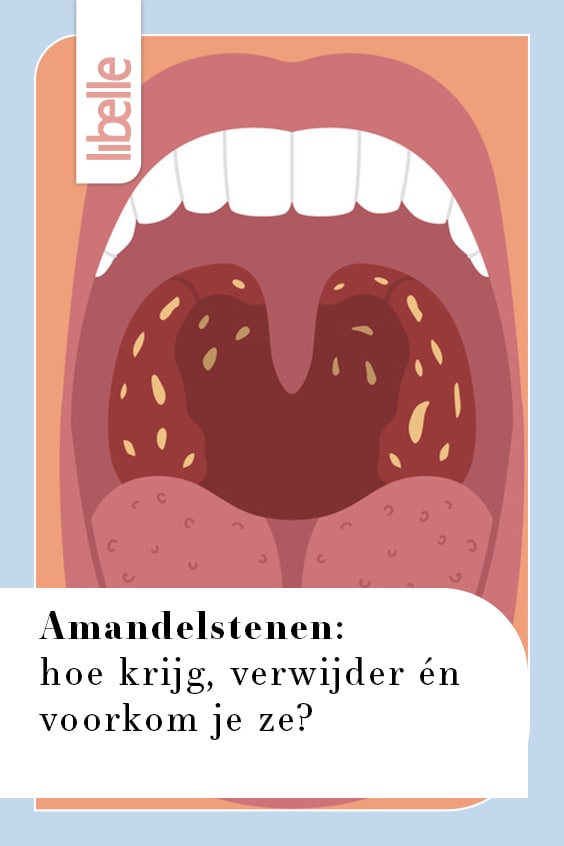Amandelstenen: hoe krijg, verwijder én voorkom je ze? | Libelle